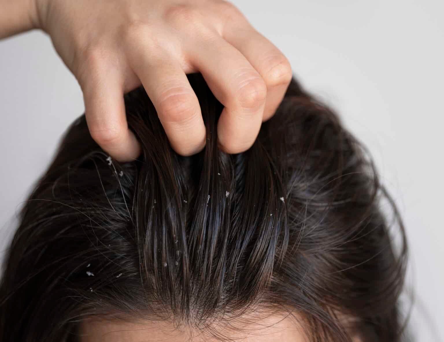 Why Dandruff Worsens in Winter & How to Combat It Effectively