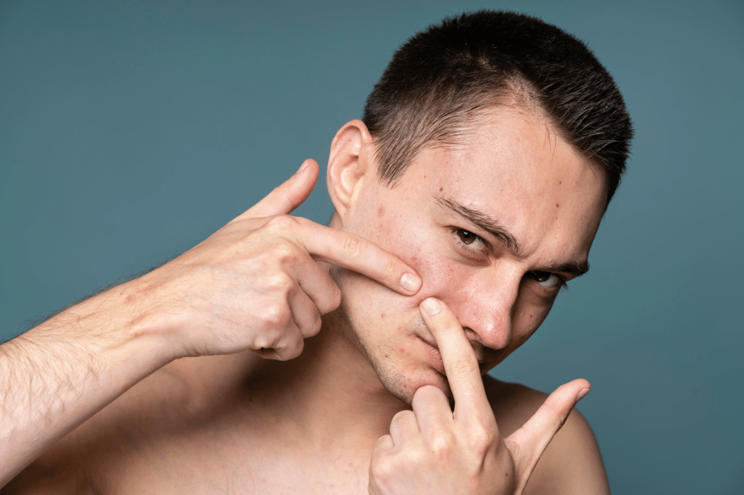 Acne & Acne Scars Treatment: What Really Works